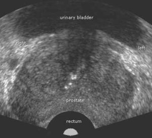 Medical Articles Blog - Transrectal Prostate Ultrasound (TRUS) - SIFSOF