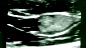 Ultrasound-Guided BBL Surgery - Brazilian Butt Lift - SIFSOF