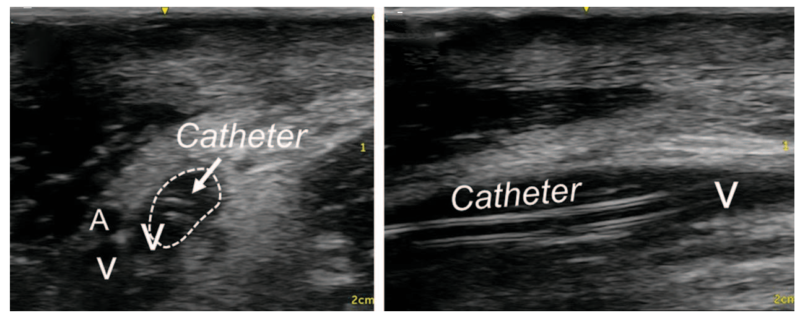 Midline Catheter Insertion (MCI) - Medical Articles By SIFSOF