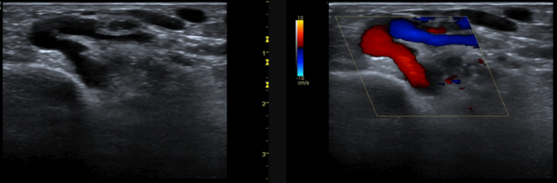 Identifying Perforators in Reconstructive Surgery - SIFSOF