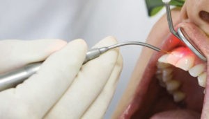 Laser Gingivectomy Sifsof