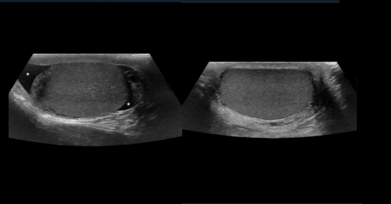 Scrotal Ultrasound - SIFSOF