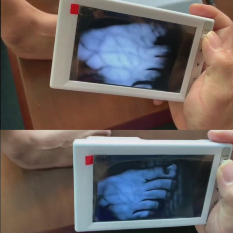 5-inch LCD Screen Portable Vein Detector : SIFVEIN-2.3 - SIFSOF